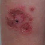 Impetigo
