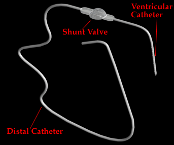 Ventriculoperitoneal shunts - Don't Forget the Bubbles